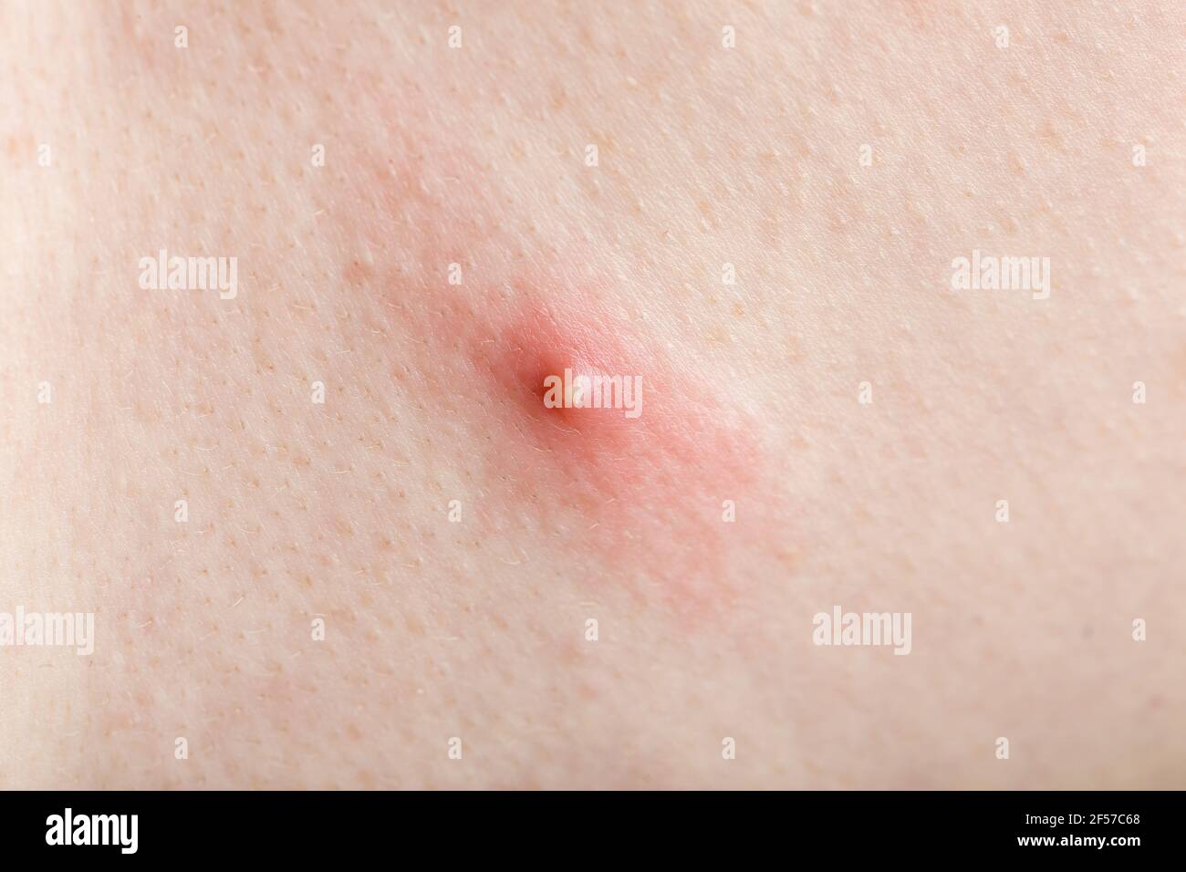 inflamed purulent pimple with pus on human body skin close-up, health ...