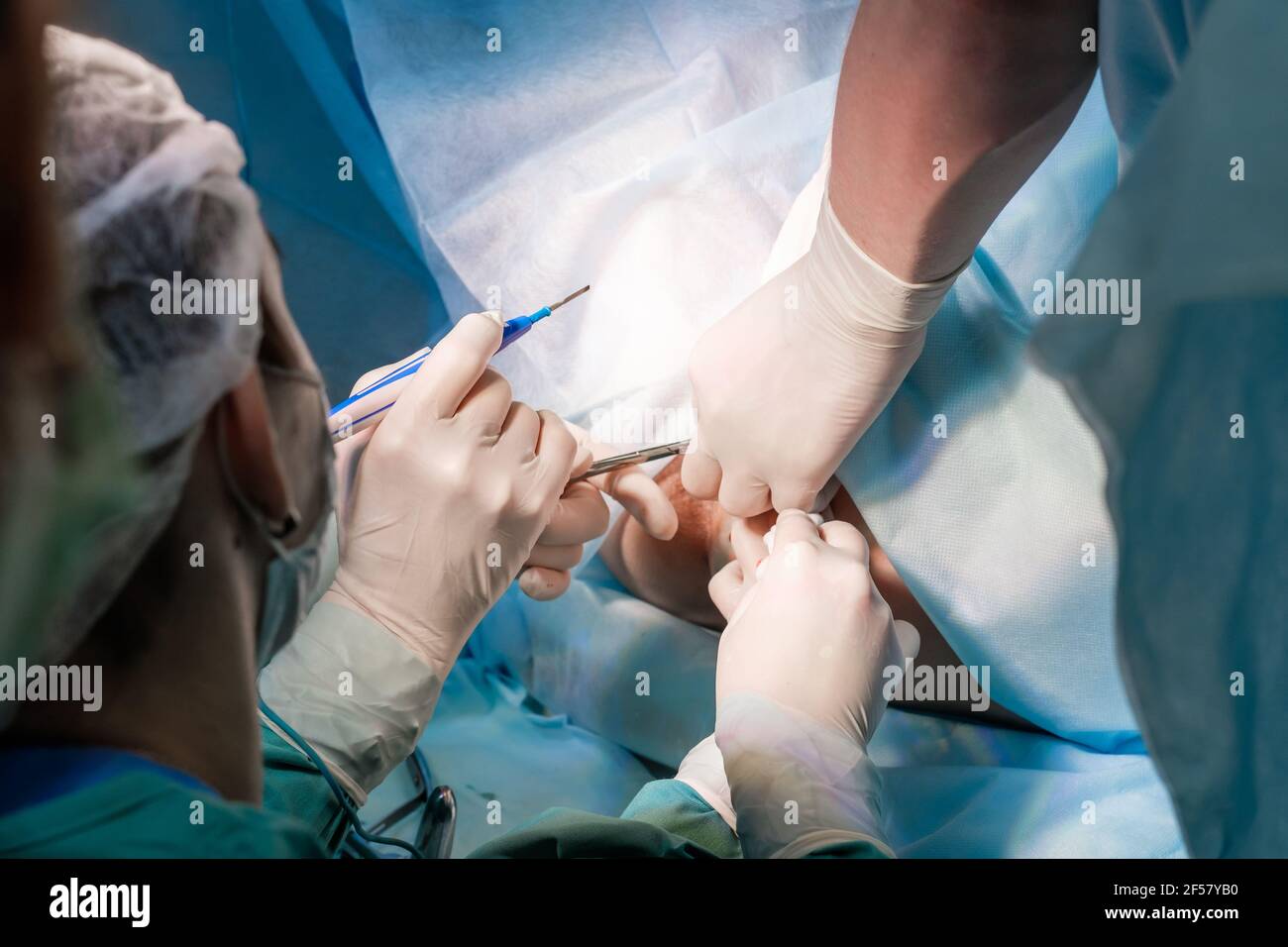 The surgeon holds the electrical coagulator during proctological ...