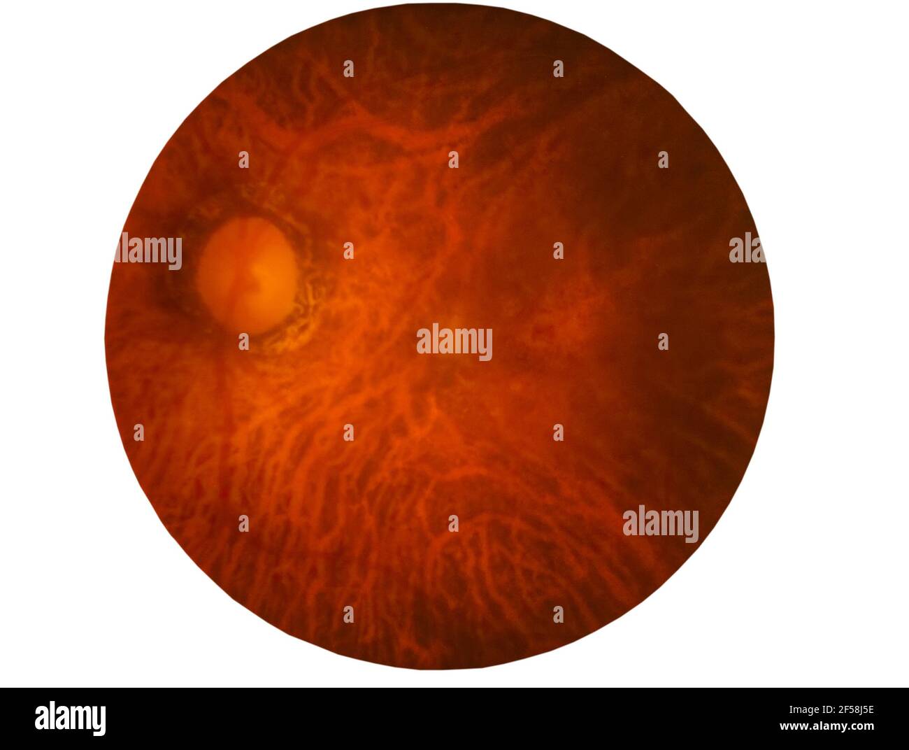 Retina of diabetes , diabates retinopathy,photo Medical Retina Abnormal ...