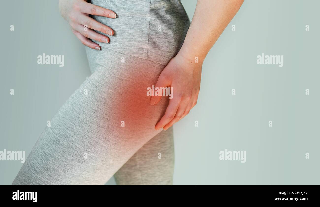 A woman suffers from piriformis syndrome, pain in buttocks muscle ...