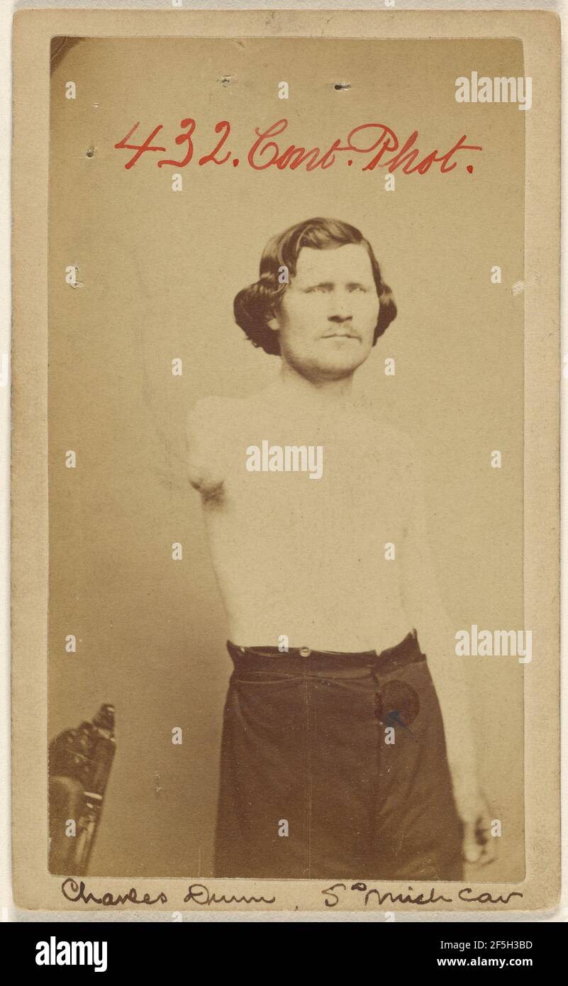 Civil war amputee union soldiers hi-res stock photography and images ...