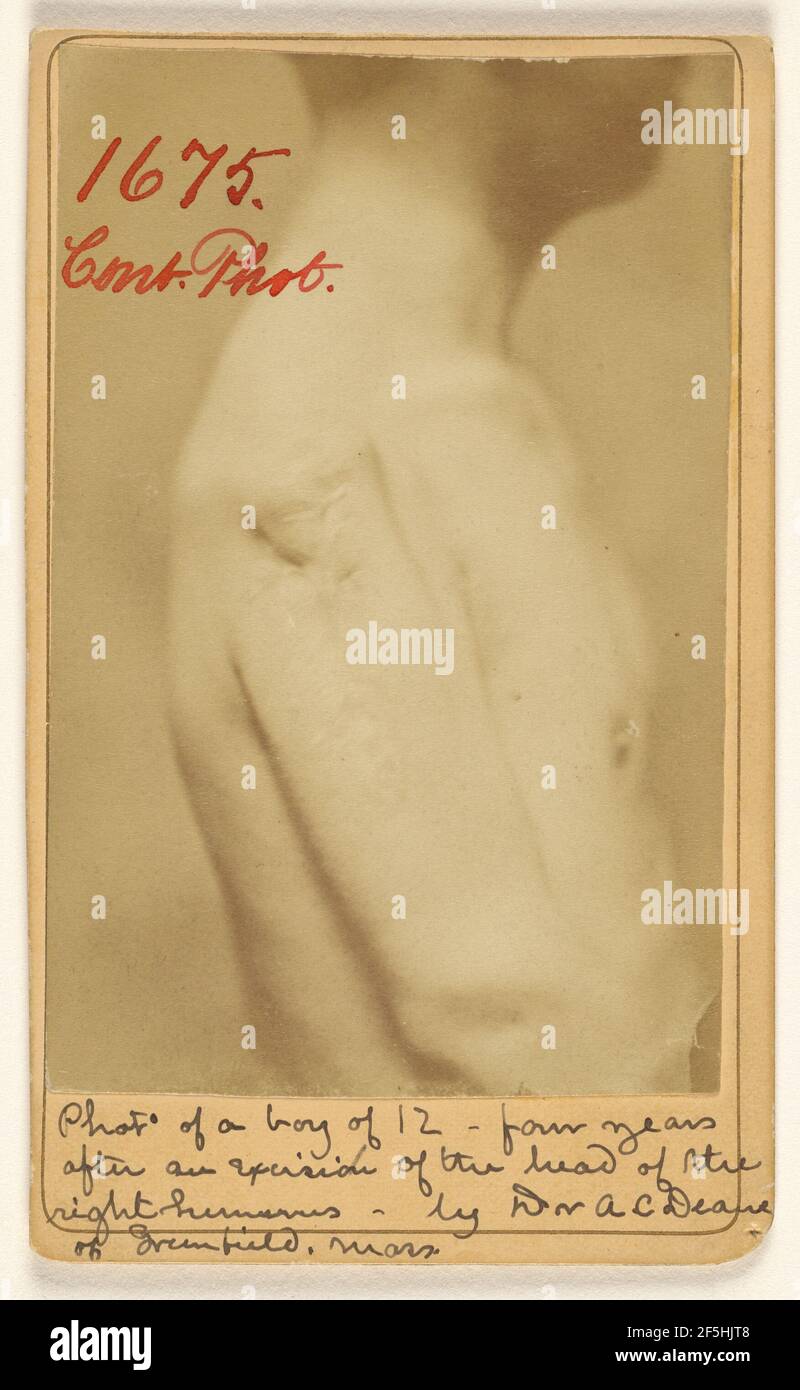 Photo of a boy of 12 - four years after an Excision of the head of the ...