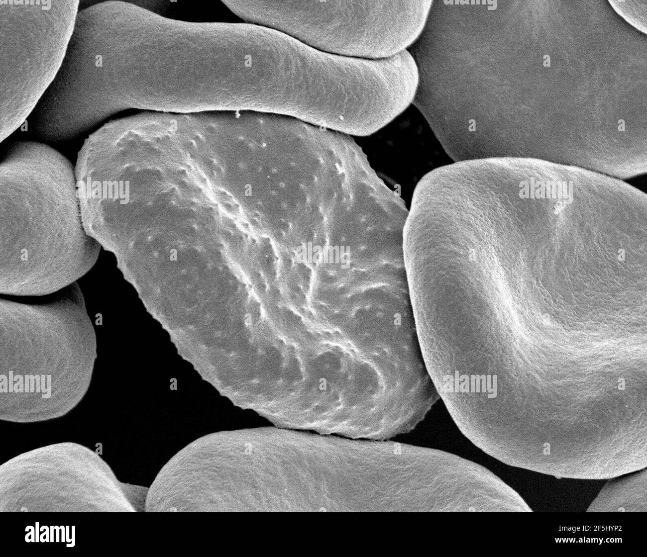 Red blood cells infected with malaria Stock Photo - Alamy