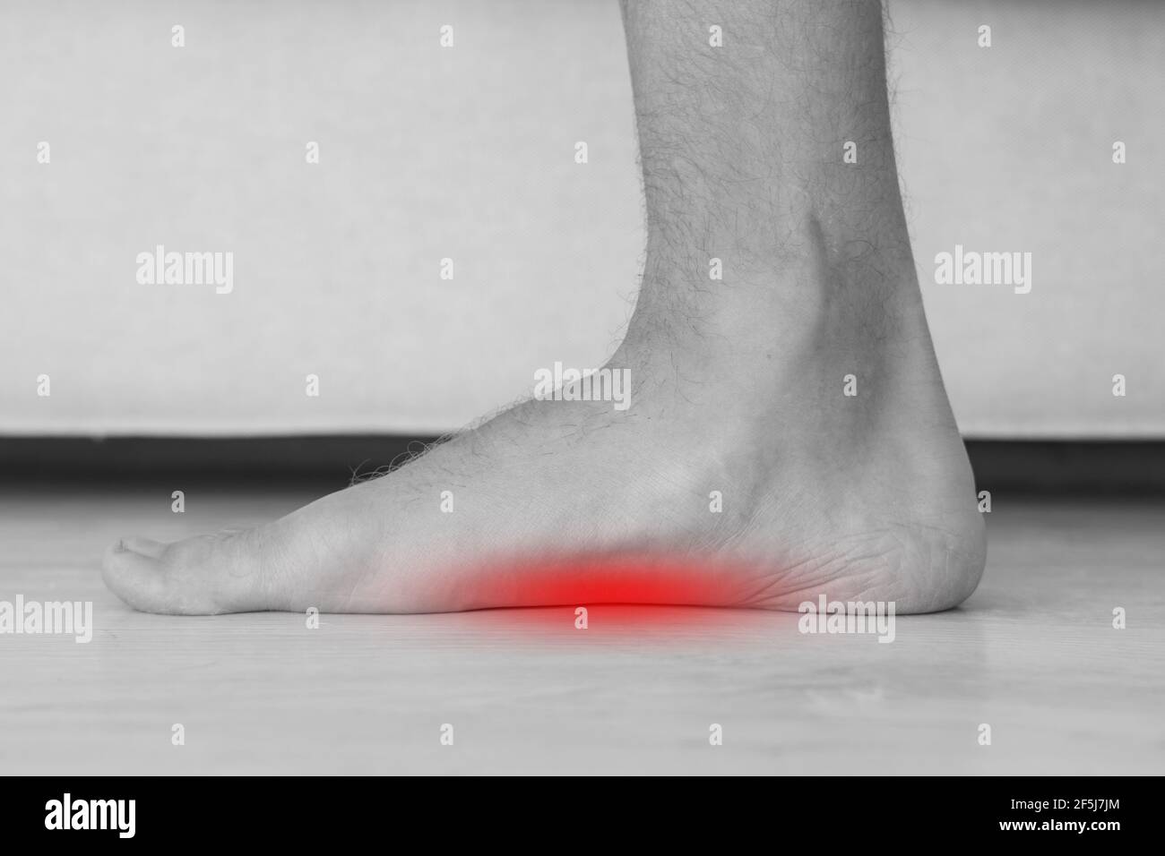 Foot pain because of strong flat feet also called pes planus or fallen ...