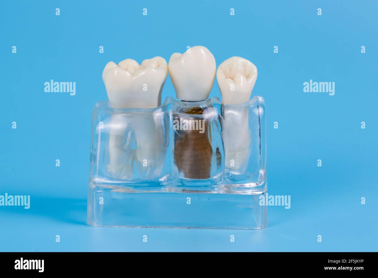 Plastic dental crowns, imitation of a dental prosthesis of a dental ...
