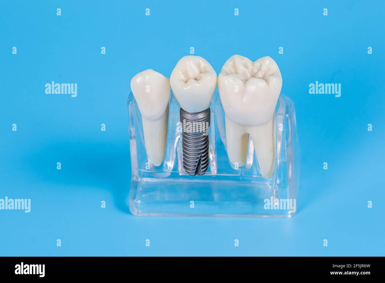 Plastic dental crowns, imitation of a dental prosthesis of a dental ...
