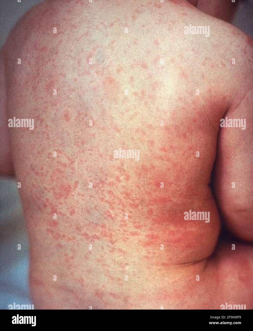 Rash of rubella on back (crop Stock Photo - Alamy