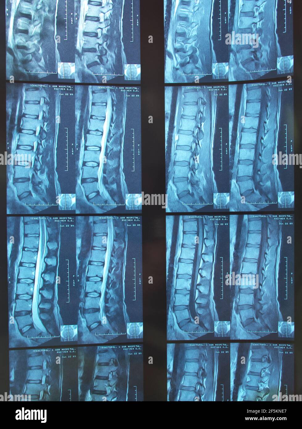 X-ray image of a human adult backbone. Medicine design Stock Photo - Alamy