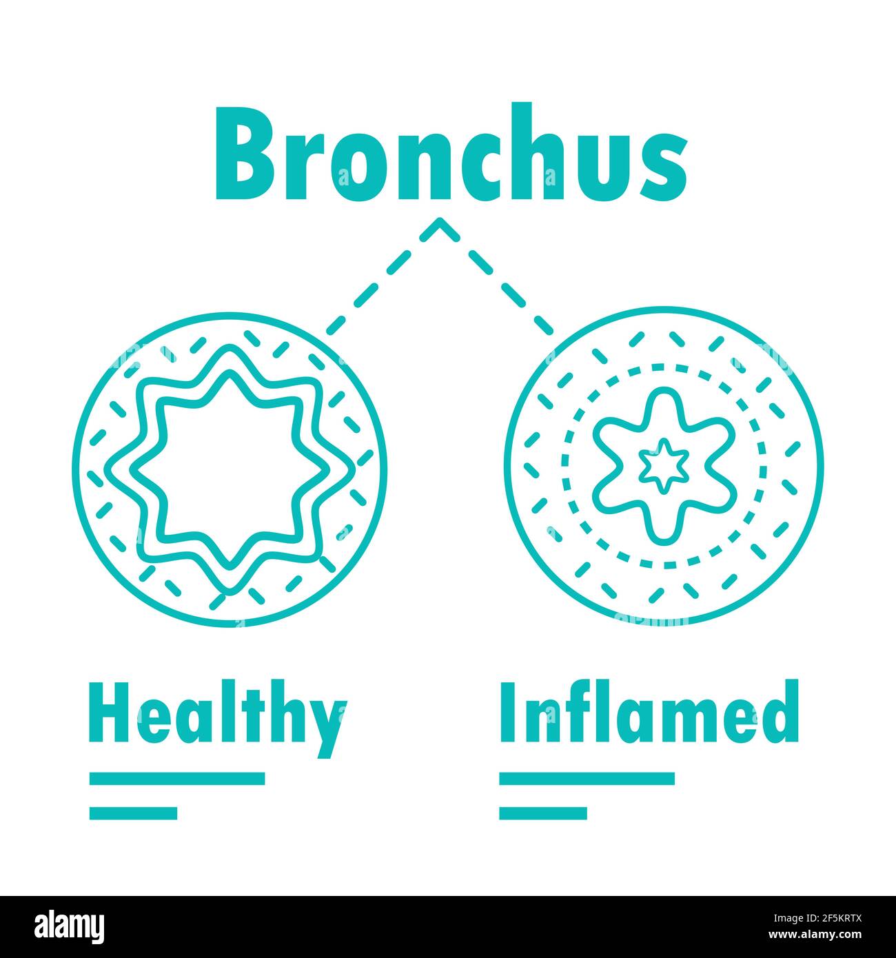 bronchus disease infographic linear style Stock Vector Image & Art - Alamy