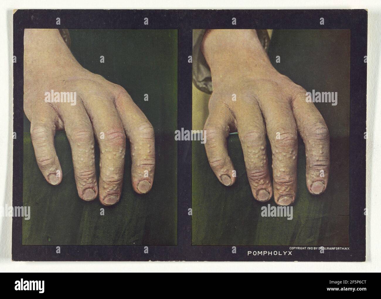 Pompholyx hi-res stock photography and images - Alamy