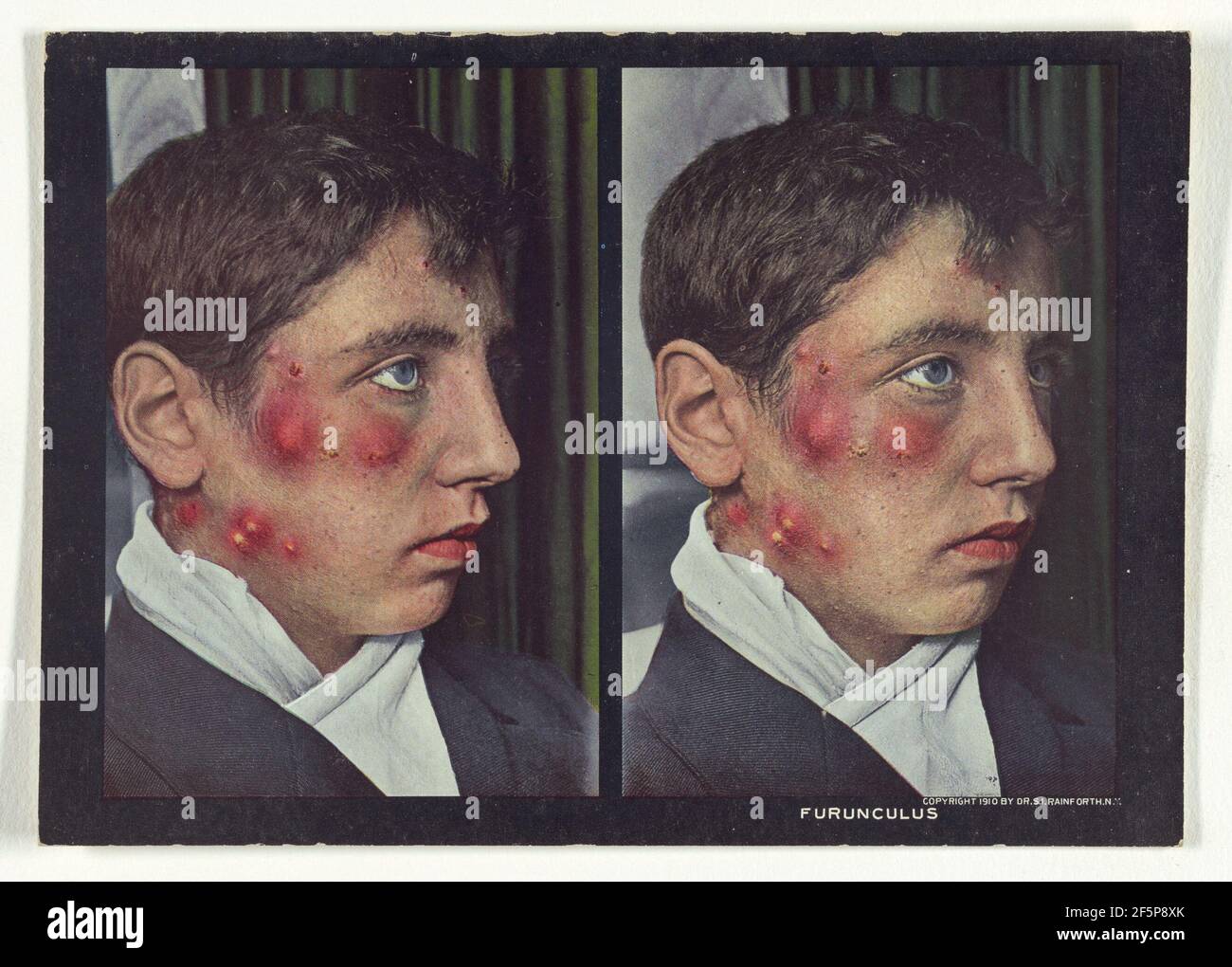 Furunculus. Dr. Selden I. Rainforth (American, 1879 - 1960 Stock Photo ...