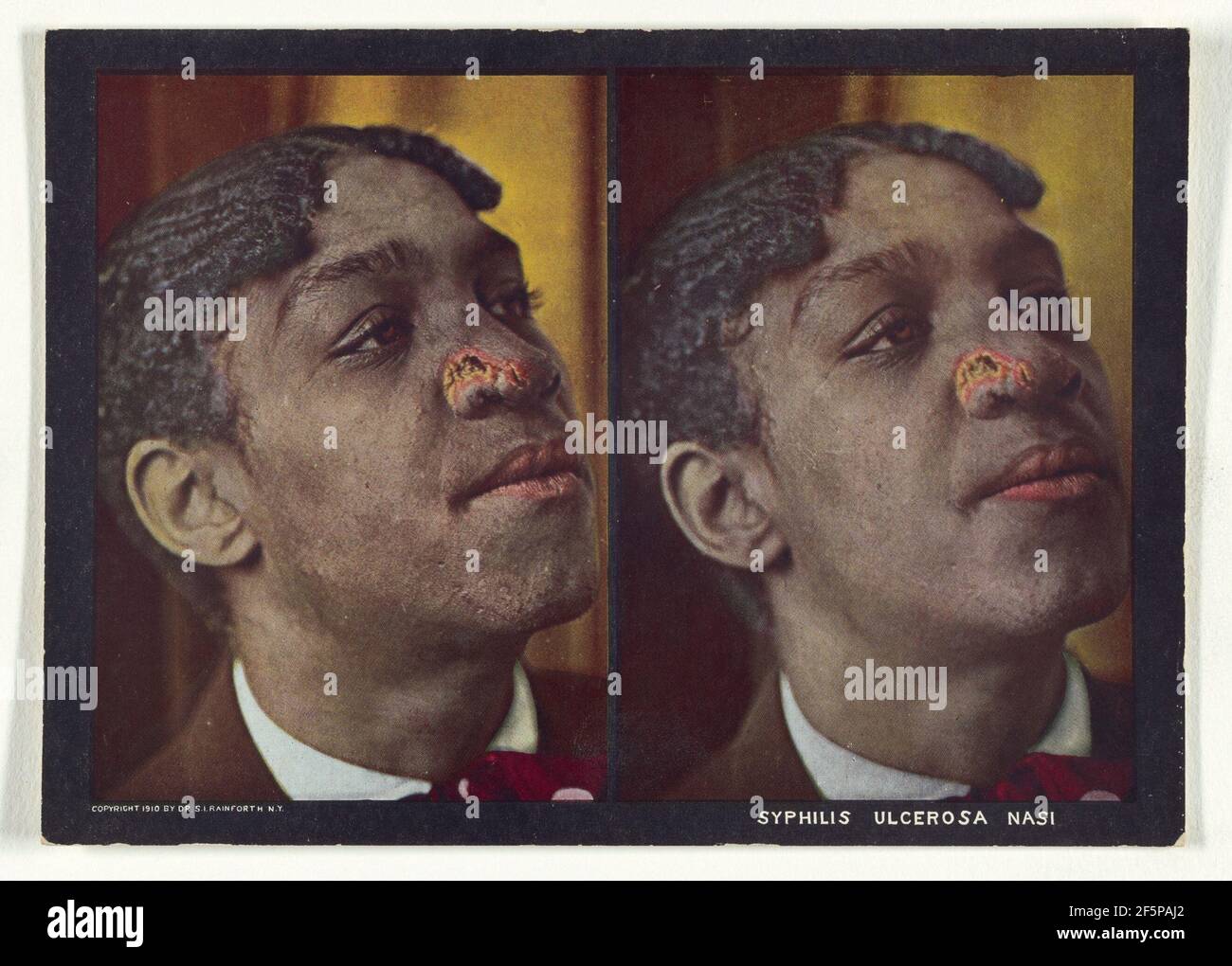 Syphilis ulcerosa nasi hi-res stock photography and images - Alamy