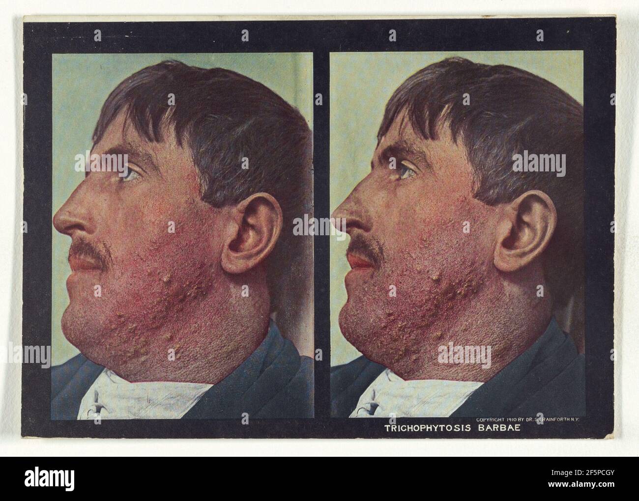 Trichophytosis hi-res stock photography and images - Alamy