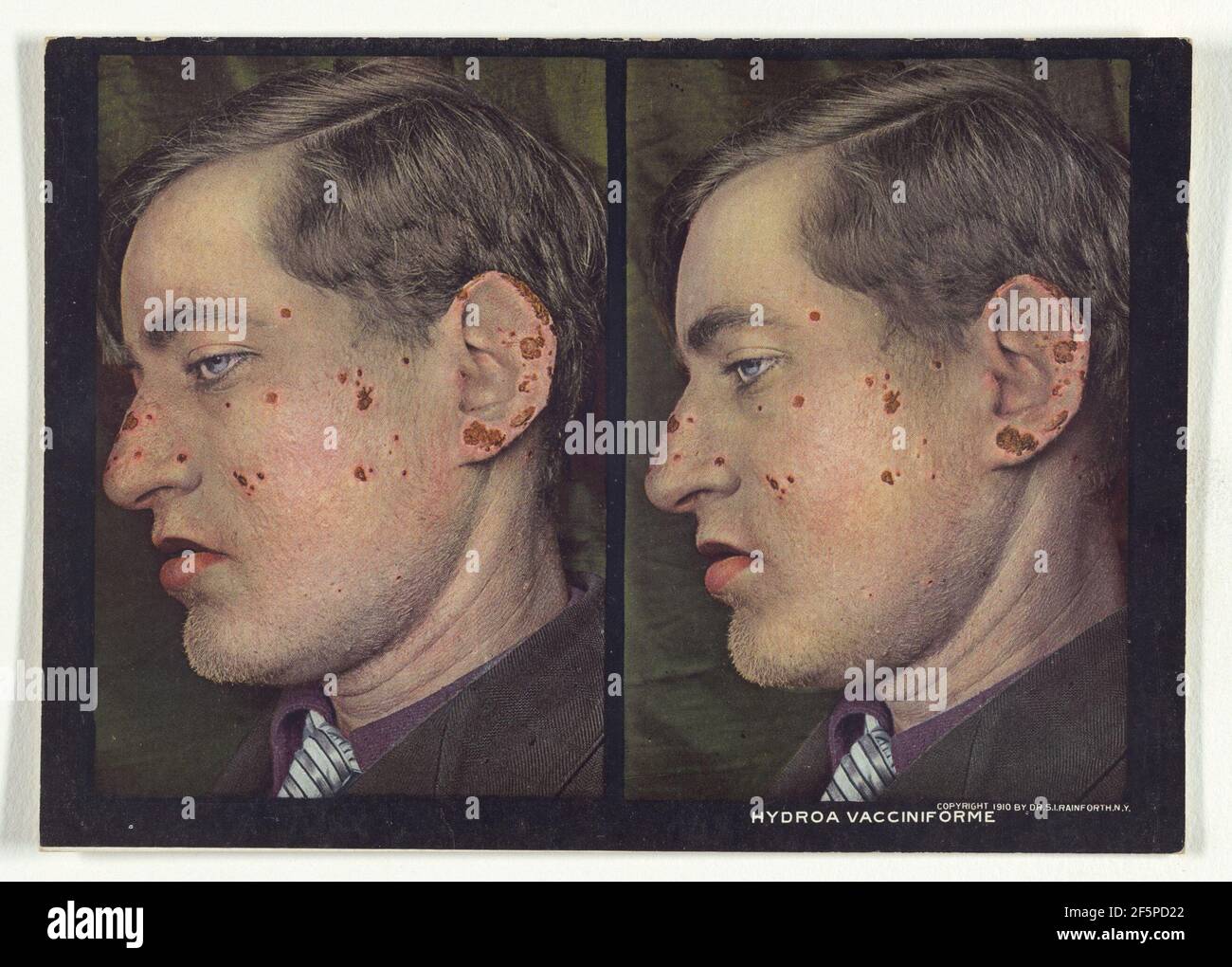 Hydroa Vacciniforme. Dr. Selden I. Rainforth (American, 1879 - 1960 ...