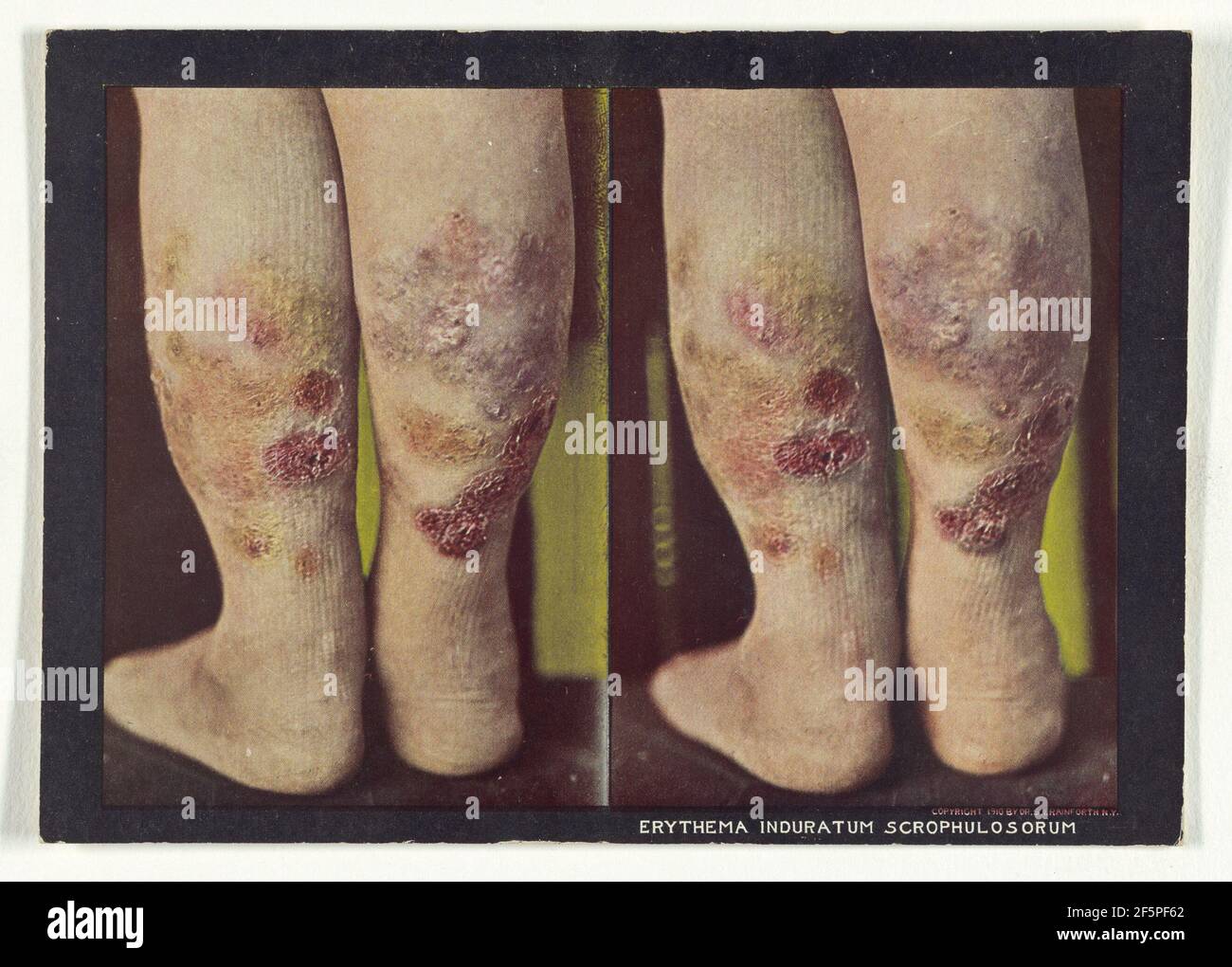 Erythema Induratum Scrofulosorum.. Dr. Selden I. Rainforth (American ...