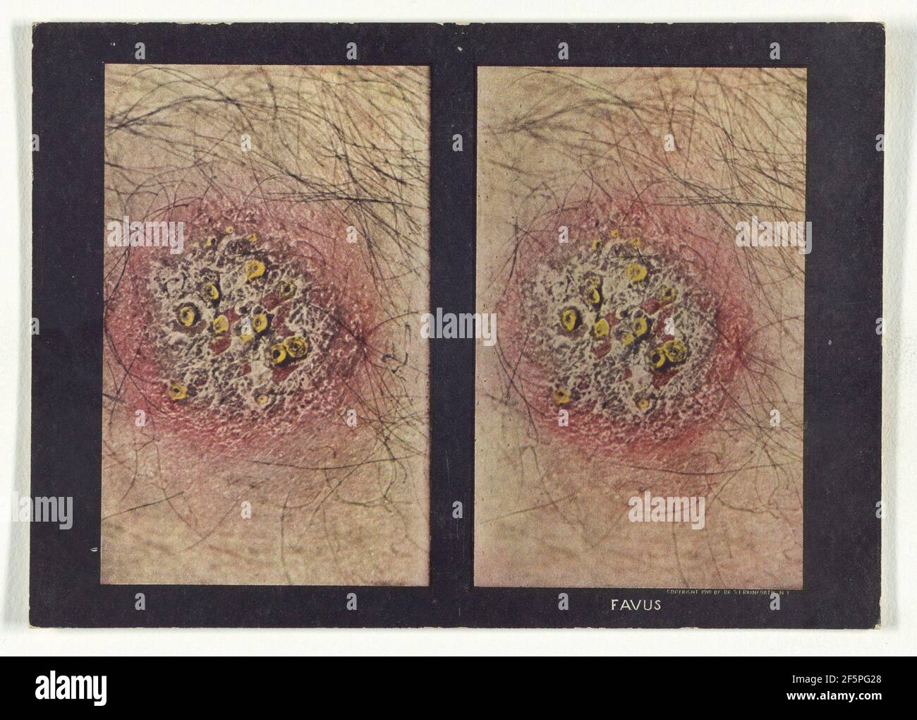 Favus hi-res stock photography and images - Alamy