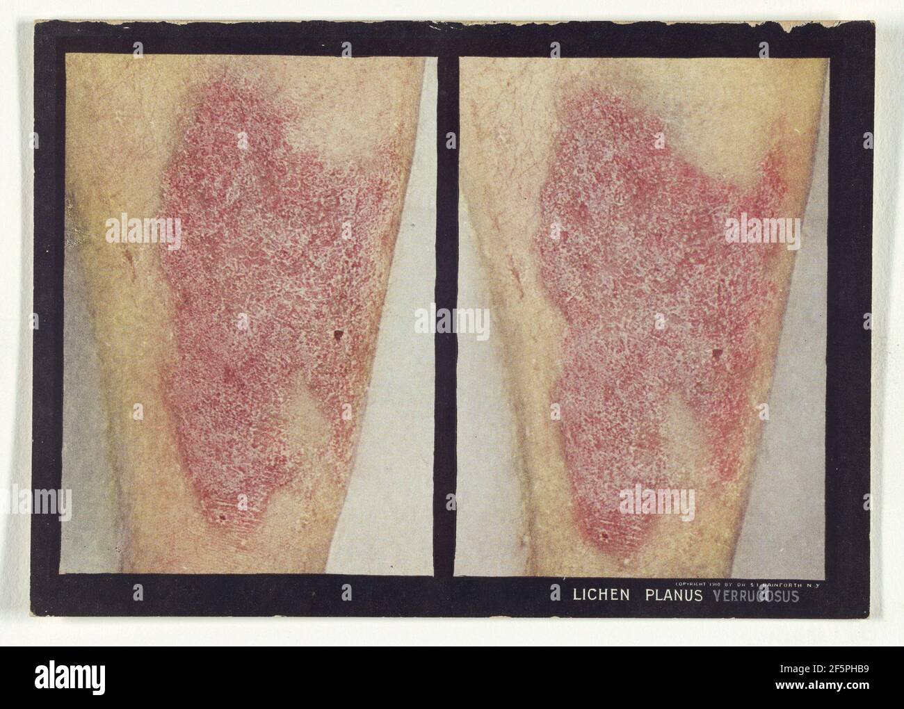 Lichen Planus Verrucosus. Dr. Selden I. Rainforth (American, 1879 ...