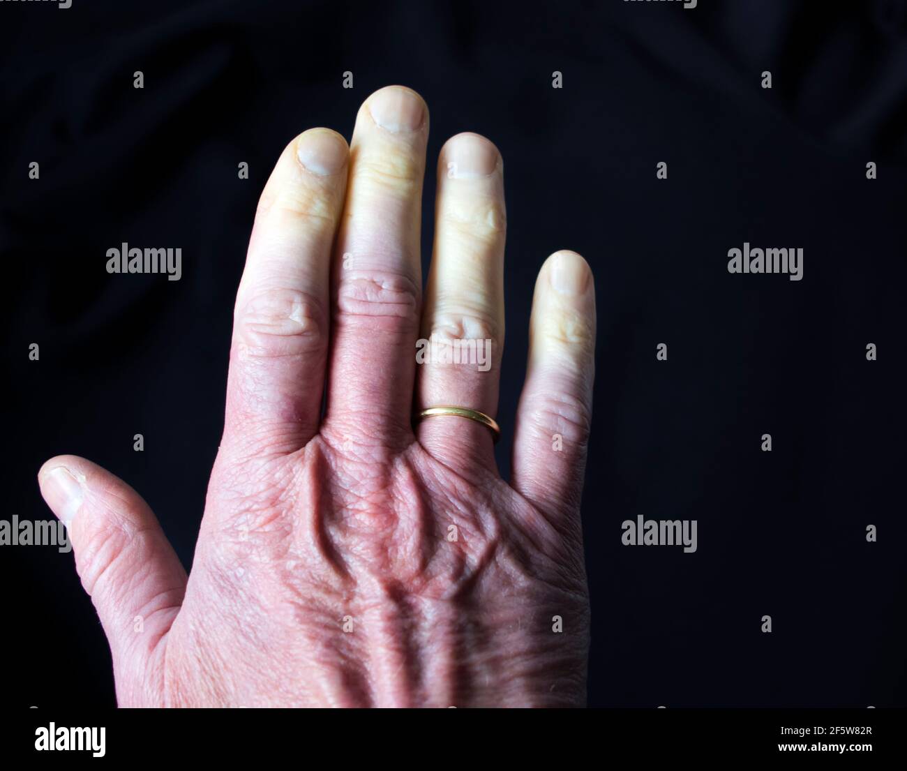 SCIENCE, MEDICINE,Raynaud syndrome. Small arteries in fingers or toes ...
