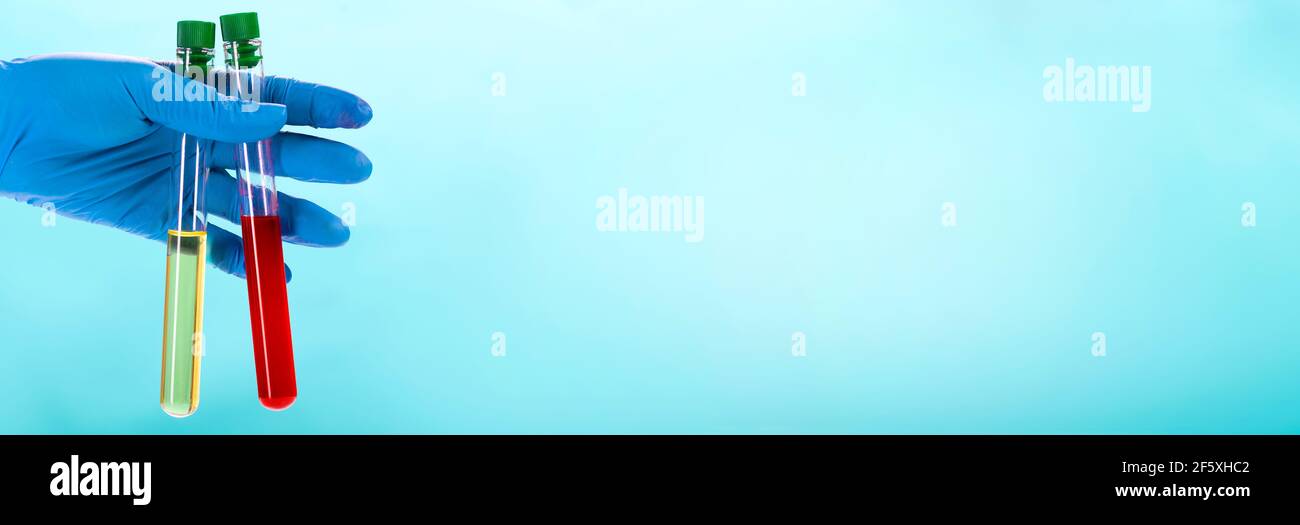 Blood test with analysis of a urine sample. Urine and blood test tubes ...