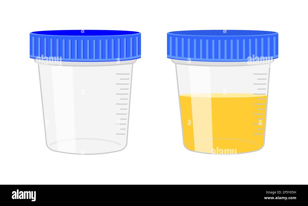 Urinalysis. Urine sample, empty and full plastic containers. Laboratory ...