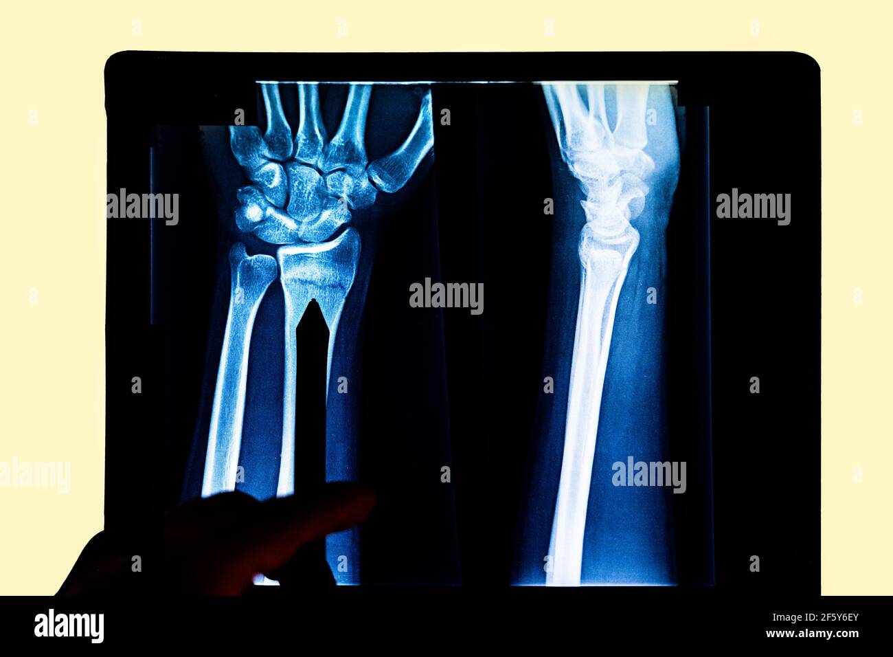 Fracture arm x ray hi-res stock photography and images - Alamy