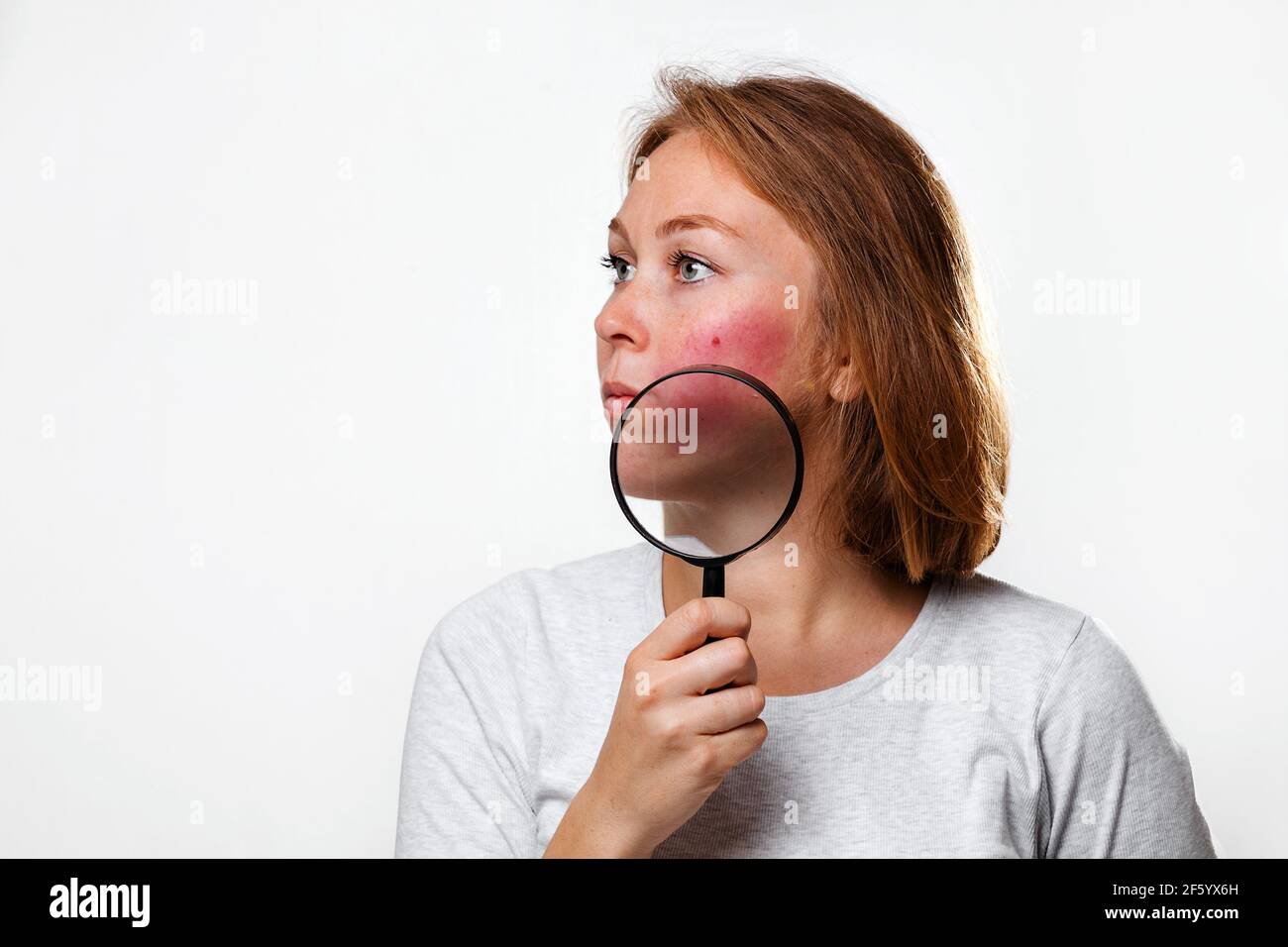 The concept of rosacea. Portrait of a caucasian woman showing redness ...