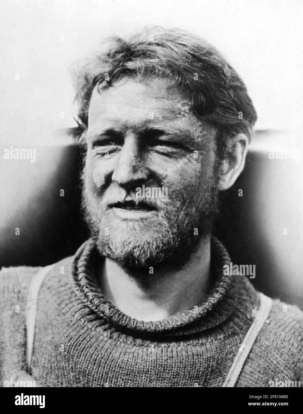 Frostbite face Black and White Stock Photos & Images - Alamy