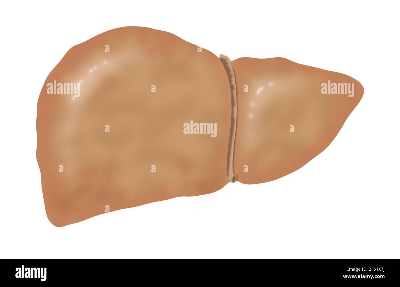 Enlarged liver hi-res stock photography and images - Alamy