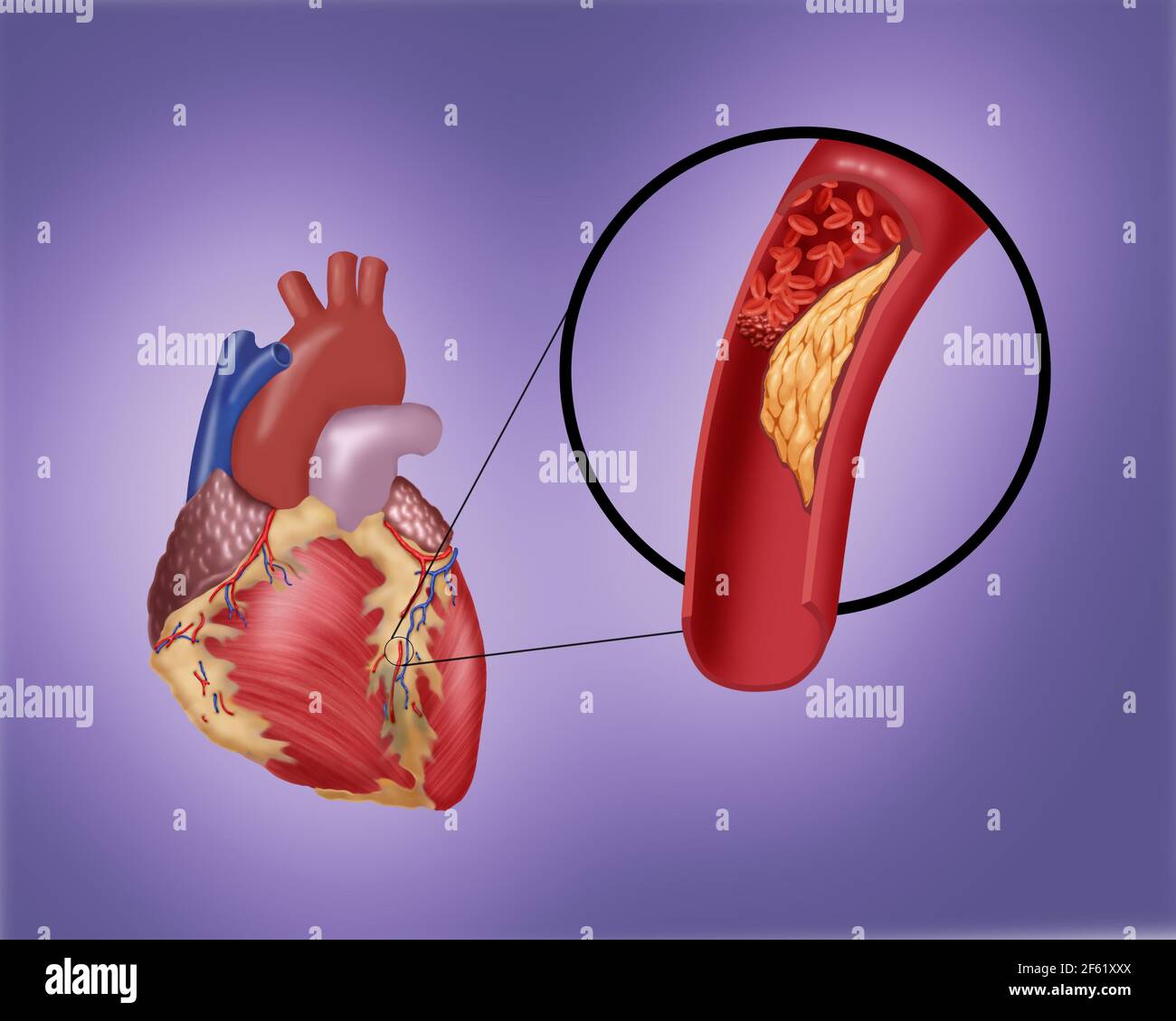 Coronary thrombosis hi-res stock photography and images - Alamy
