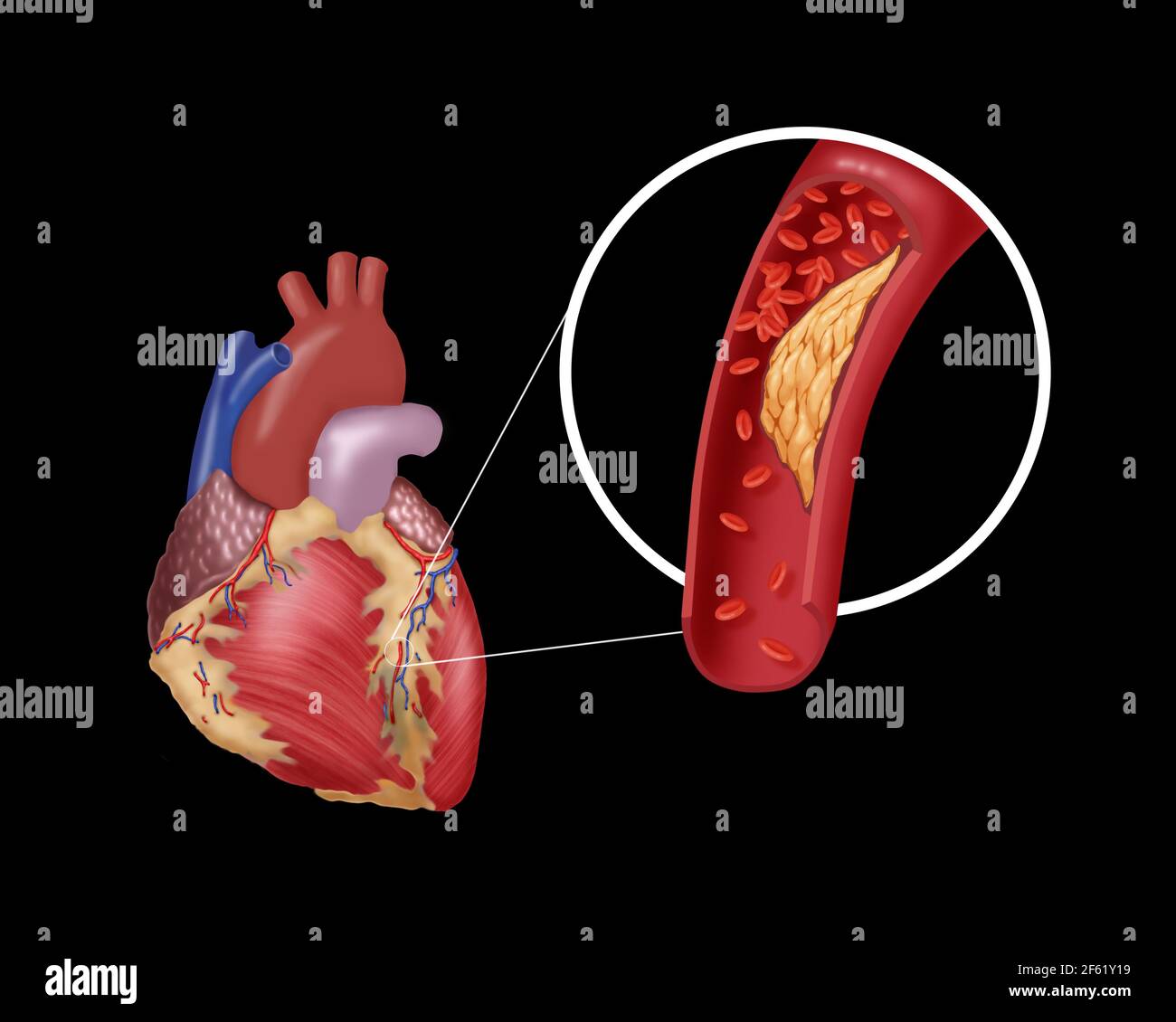 Atherosclerotic Coronary Artery Disease Stock Photo - Alamy