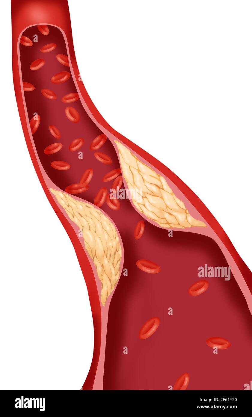 Atherosclerosis plaque hi-res stock photography and images - Alamy