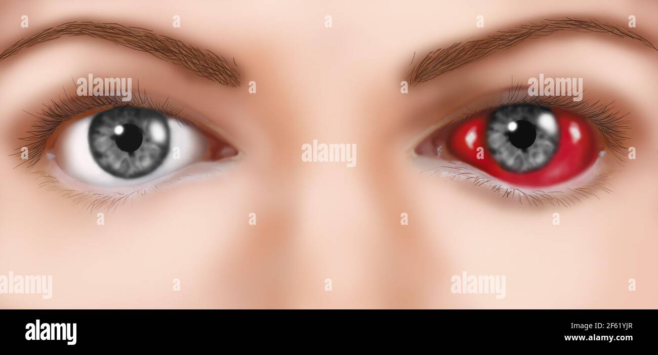 Eye hemorrhage hi-res stock photography and images - Alamy