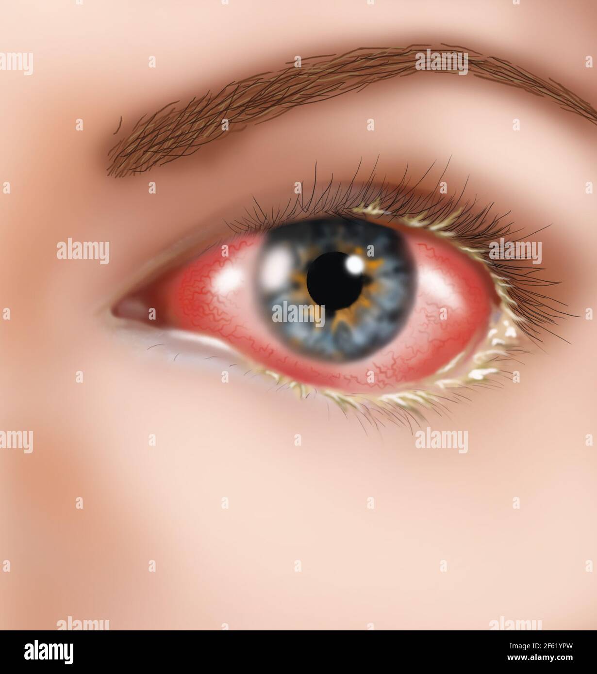 Viral conjunctivitis hi-res stock photography and images - Alamy