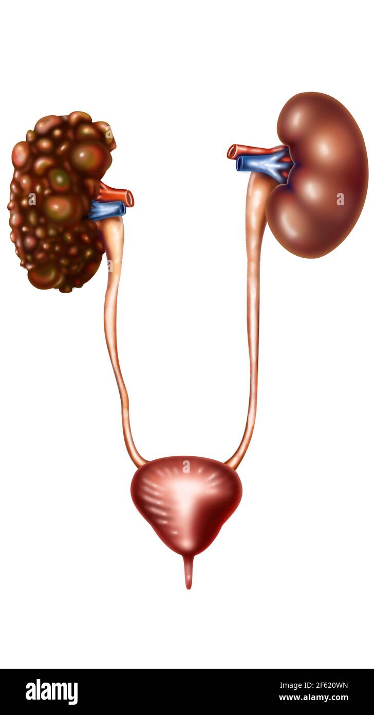 Renal disease Cut Out Stock Images & Pictures - Alamy