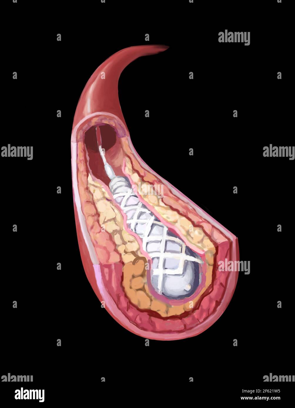 Clogged Artery Stent Stock Photo - Alamy