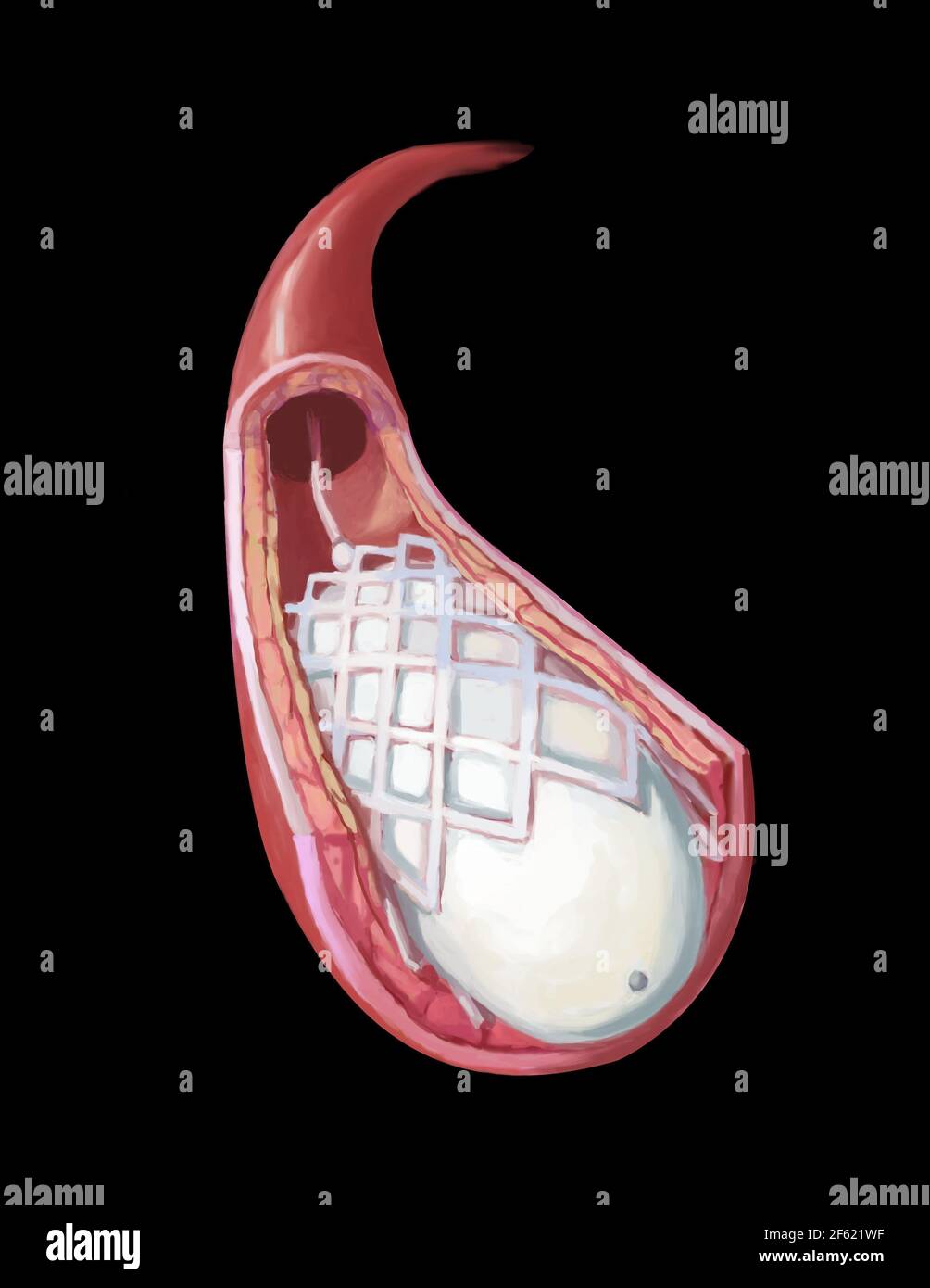 Clogged Artery Stent Stock Photo - Alamy