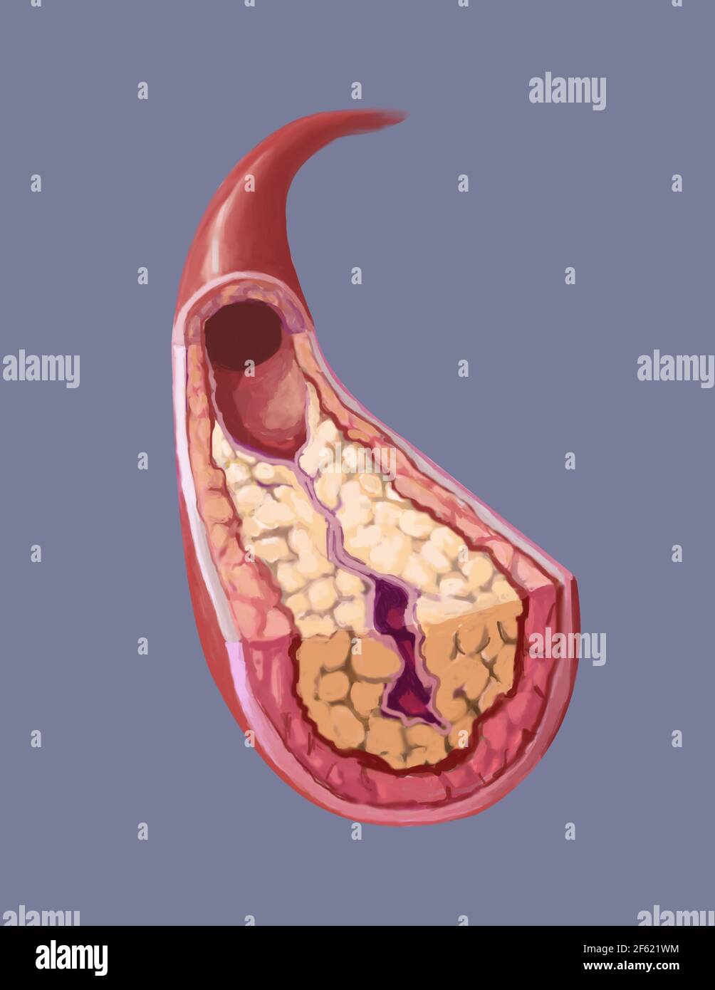 Artery blockage hi-res stock photography and images - Alamy