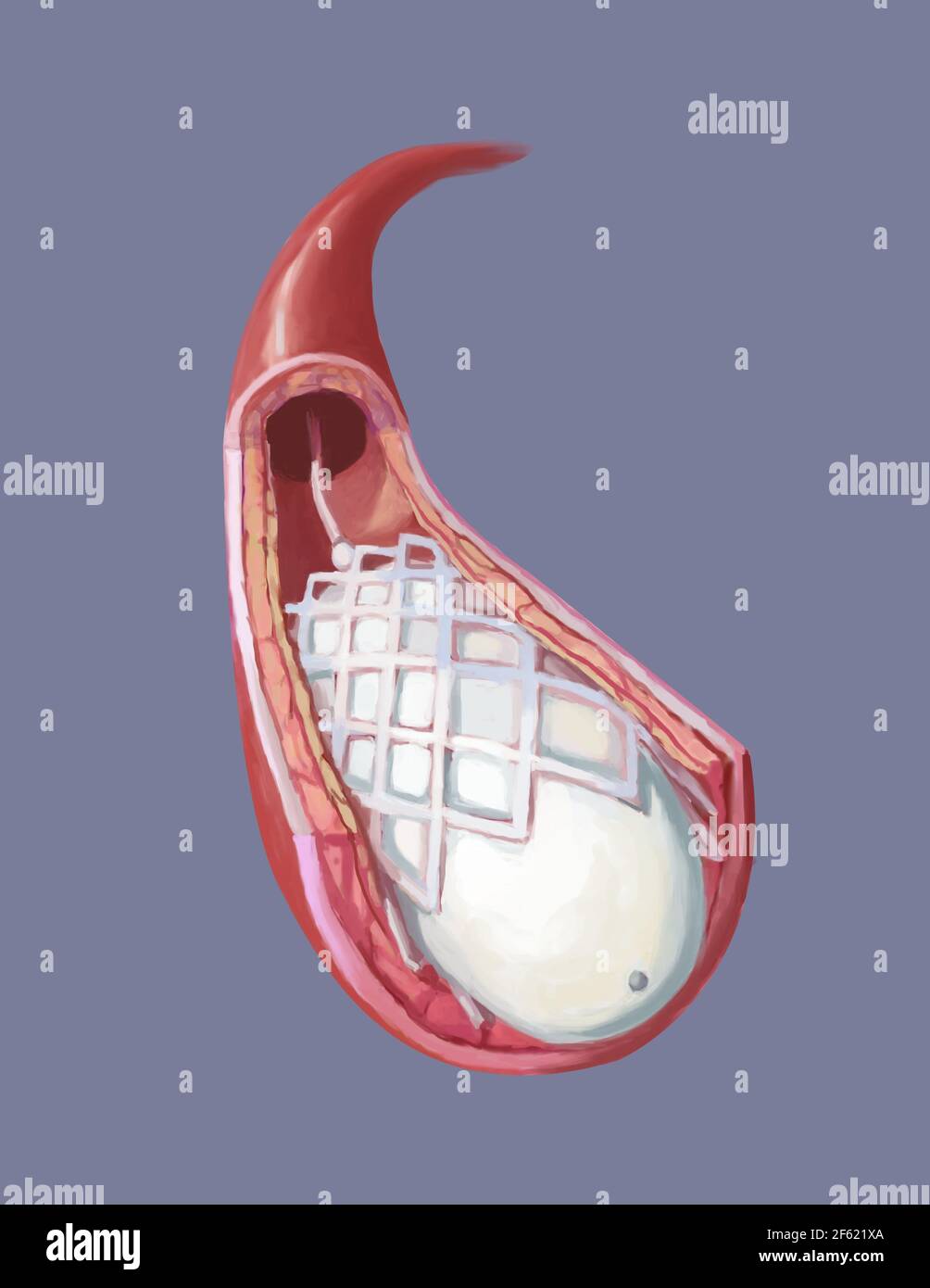Clogged Artery Stent Stock Photo - Alamy