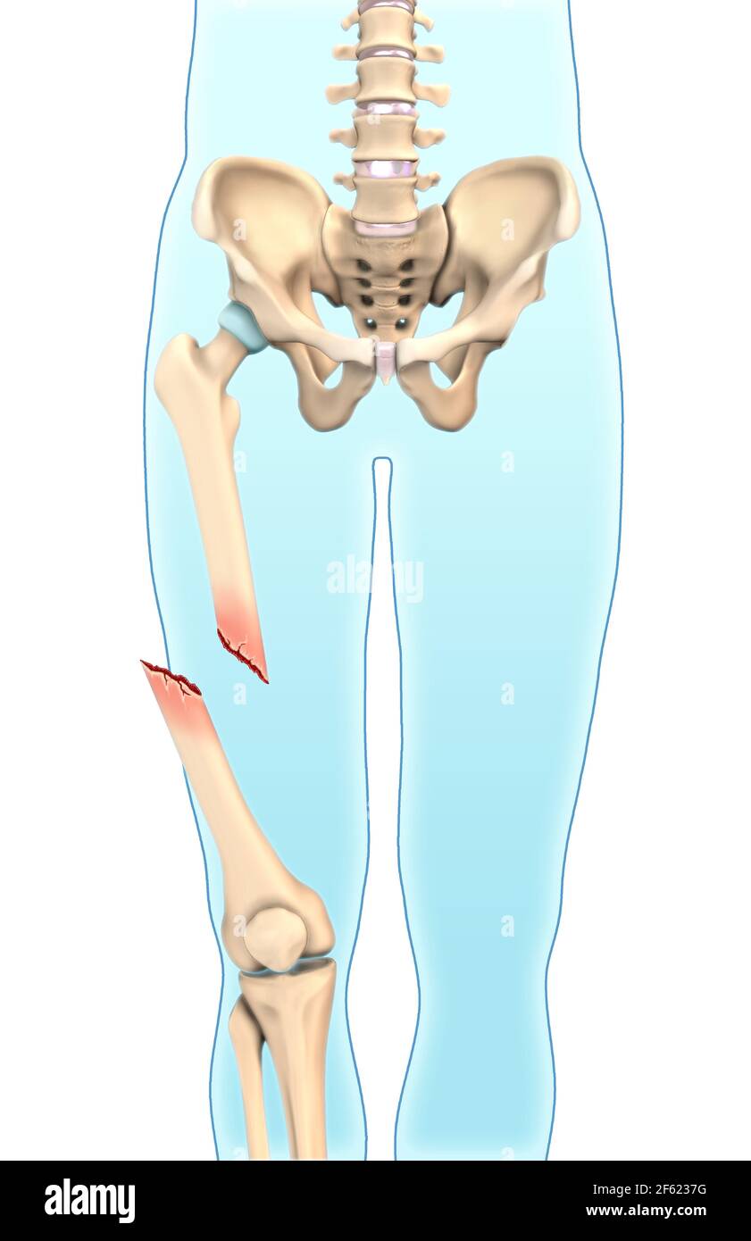 Compound Bone Fracture, Illustration Stock Photo - Alamy