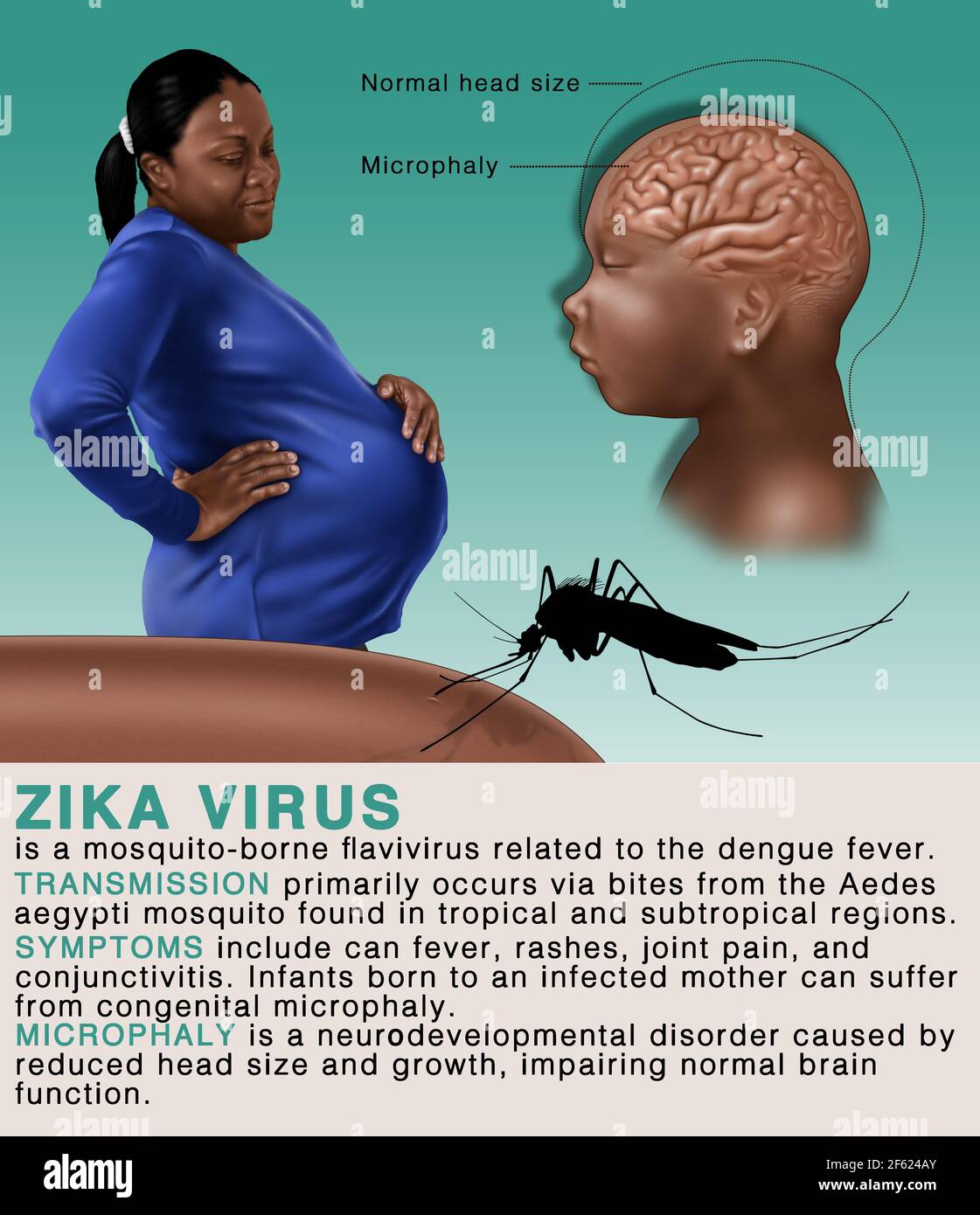 Microcephalic hi-res stock photography and images - Alamy