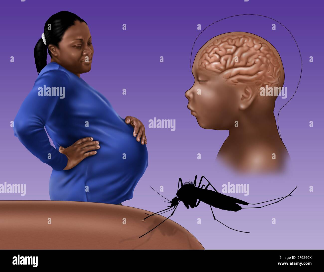 Microcephaly, Zika Virus, Illustration Stock Photo - Alamy