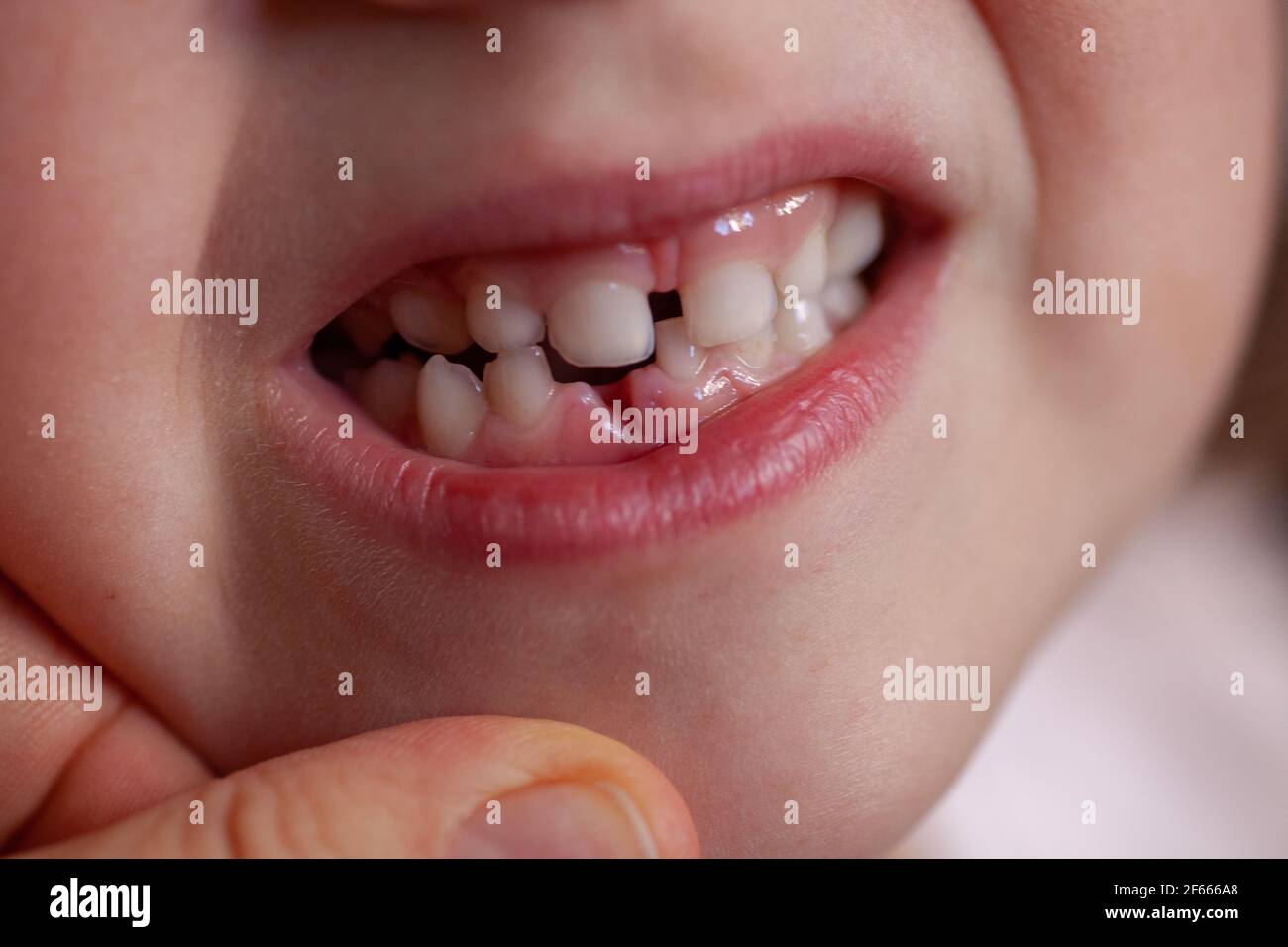 Close-up macro of a child's slightly open mouth with teeth removed in ...