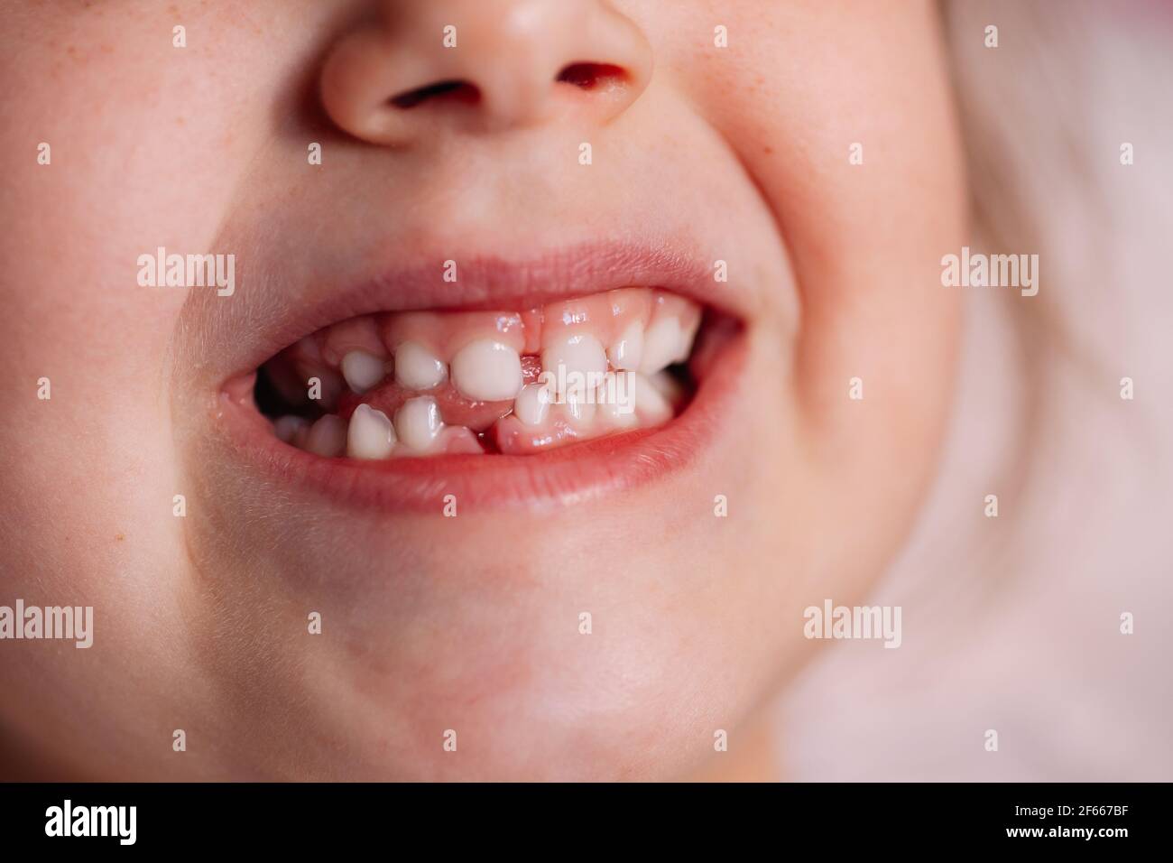 close-up clenched teeth of a five-year-old child showing a recent gum ...