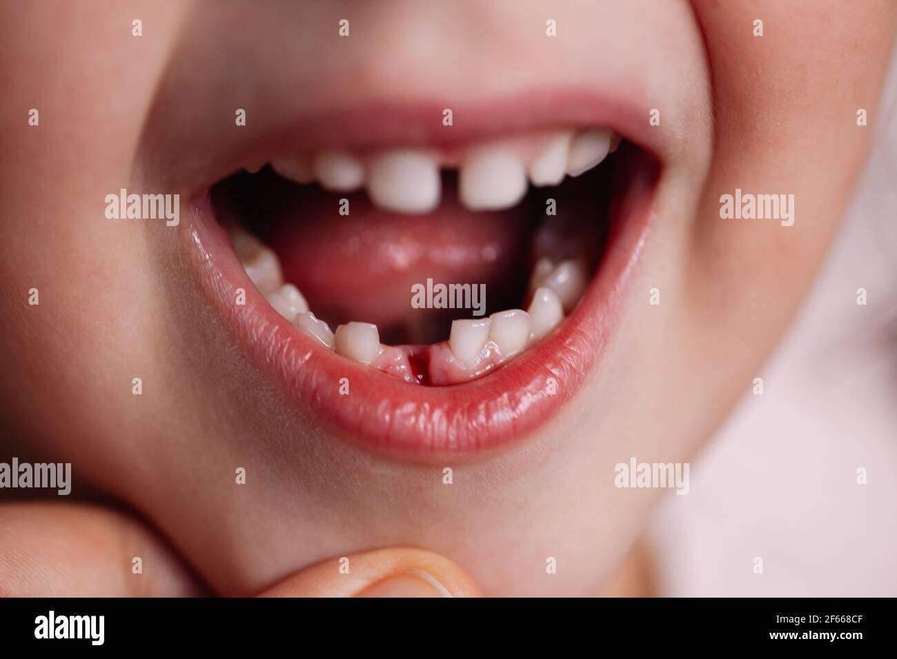 close-up new wound with blood in the lower gum from the first fallen ...