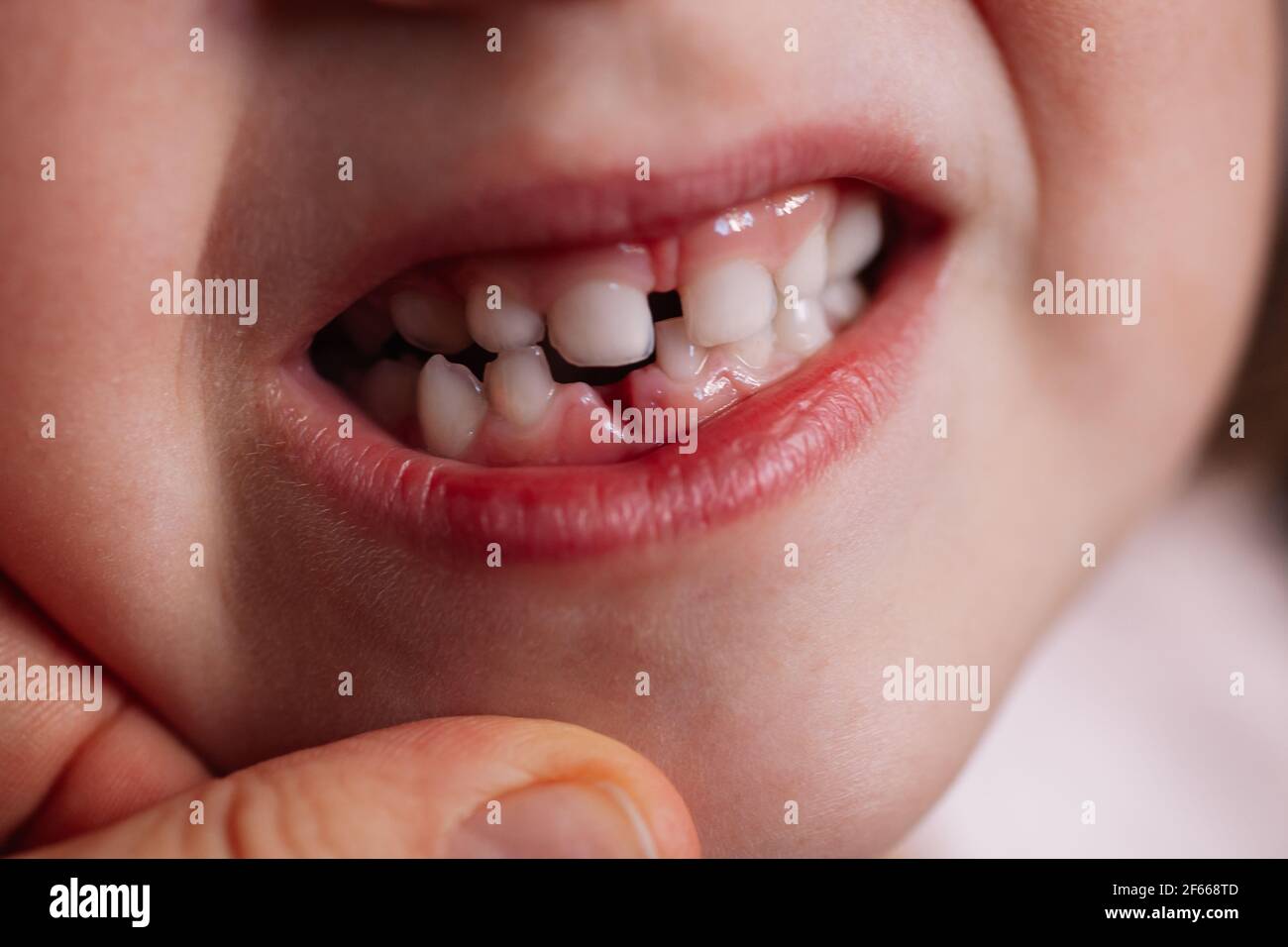 close-up macro toothless mouth with a wound from a removed temporary ...