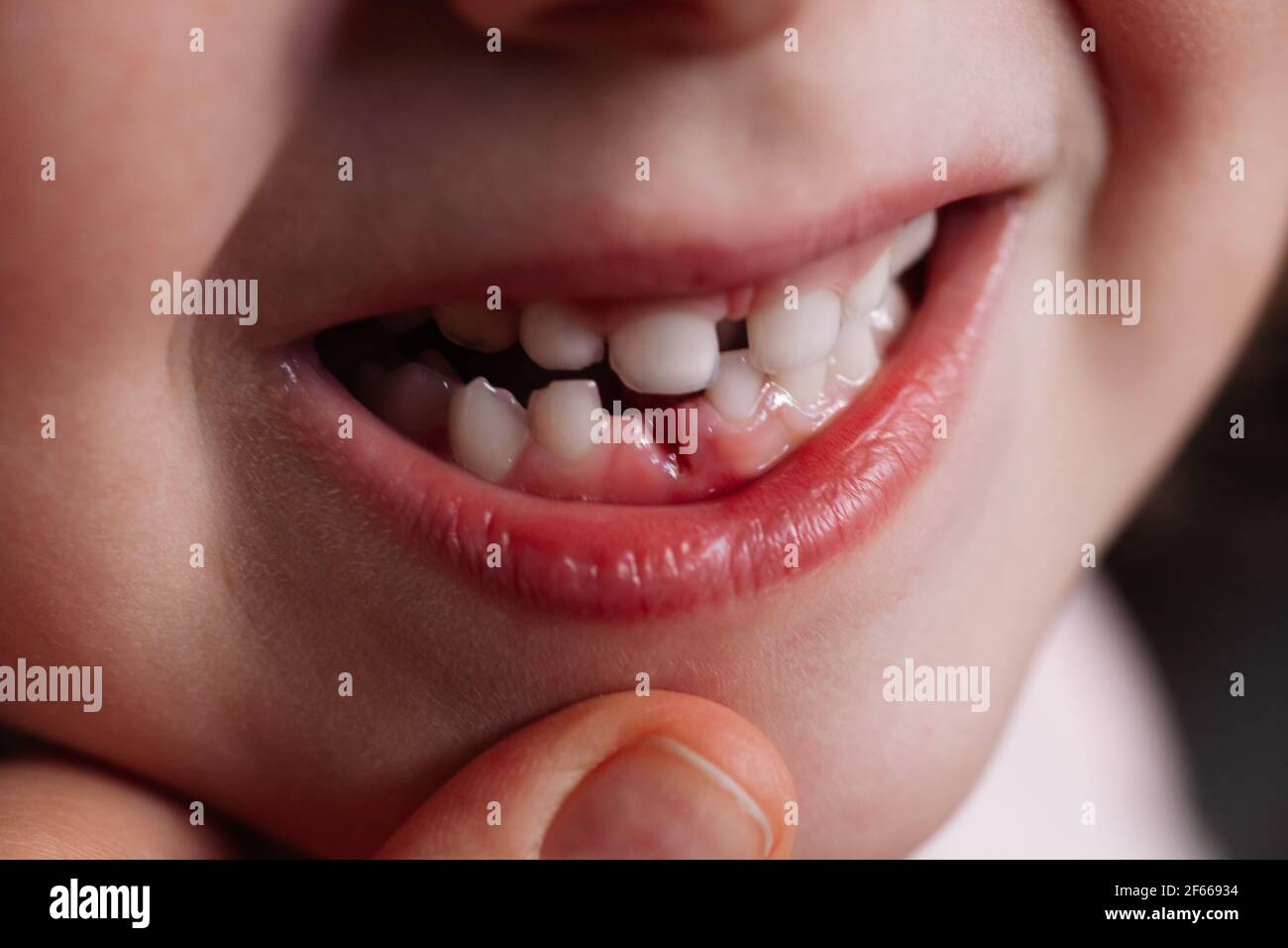 Child tooth hi-res stock photography and images - Alamy