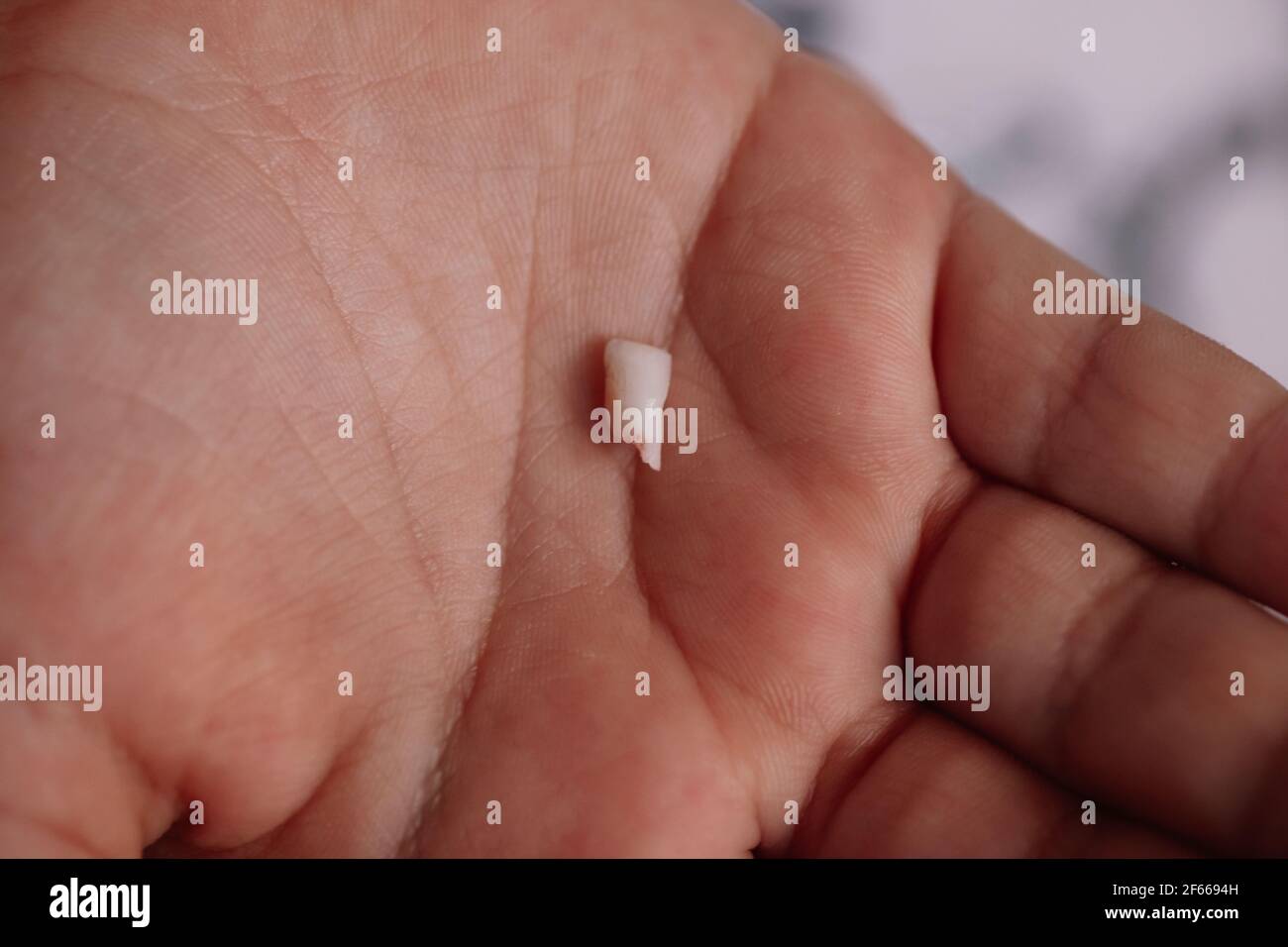 Child incisor teeth hi-res stock photography and images - Alamy