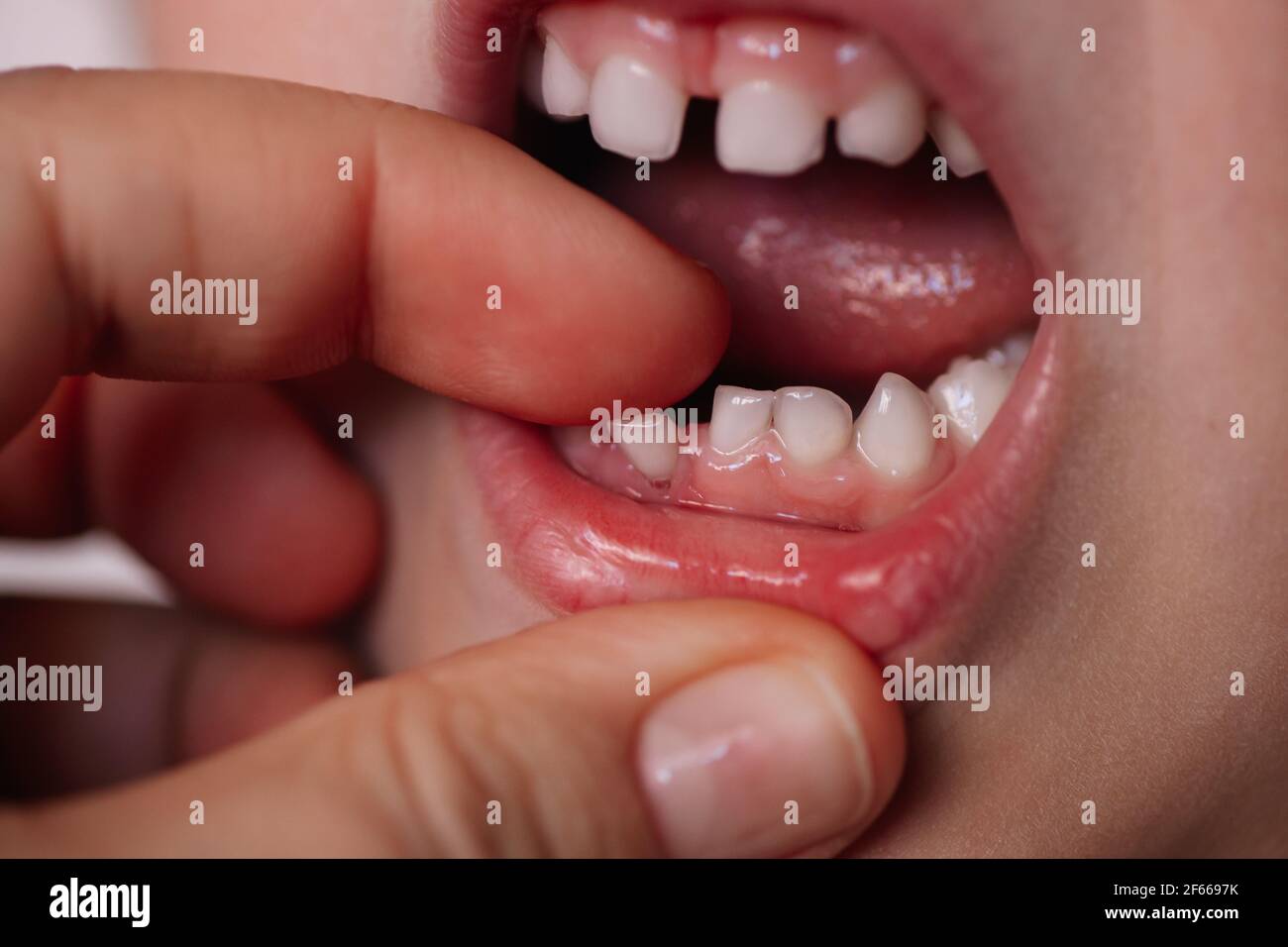 Teeth falling out hi-res stock photography and images - Alamy