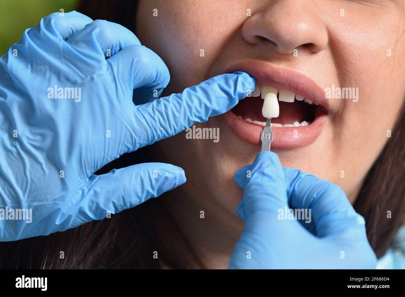 Color match teeth patient hi-res stock photography and images - Alamy