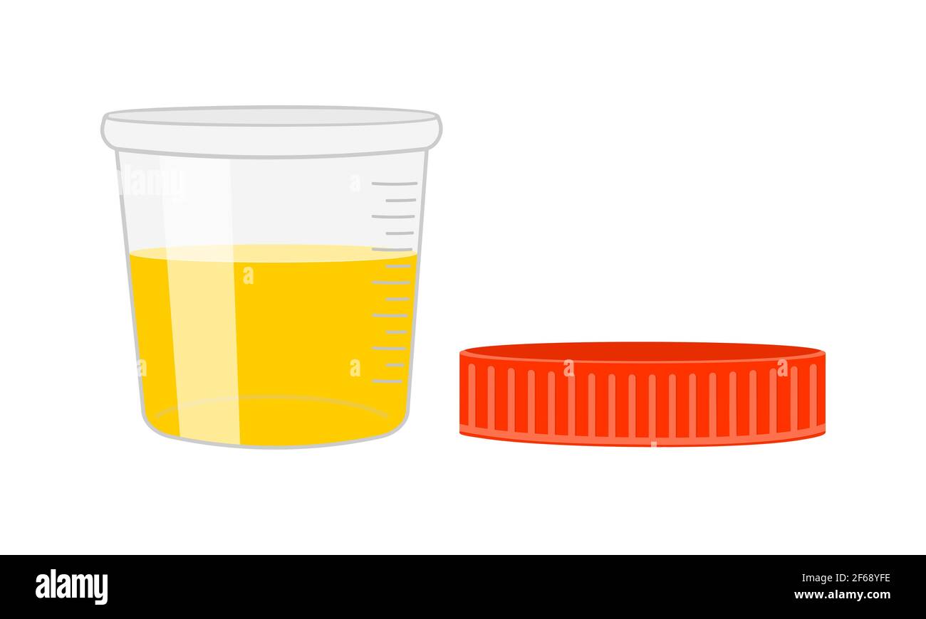 Urinalysis. Urine sample, full open plastic container with removed ...